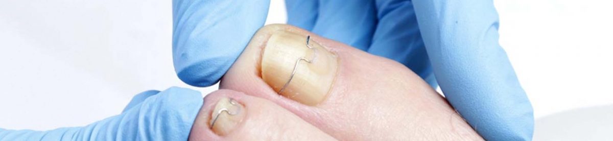 Orthonyxie (Nagelbeugel) | Podotherapie Bas Bartels